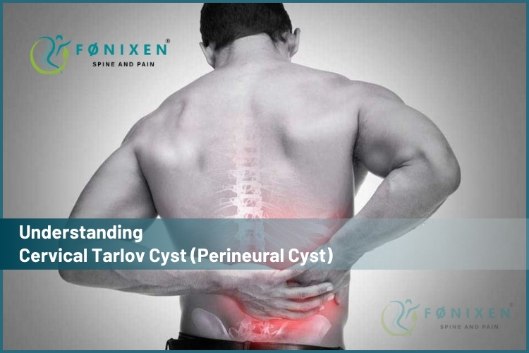Understanding Cervical Tarlov Cyst (Perineural Cyst) - Fønixen Spine Pain